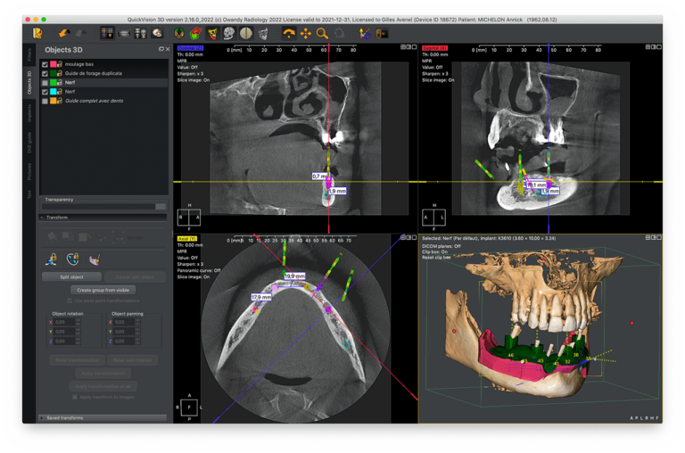 Dental Impression Scanner - Owandy-IOS