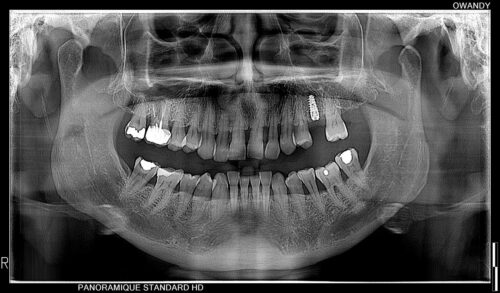 Cephalometric dental panoramic X-ray - I-Max Ceph Pro