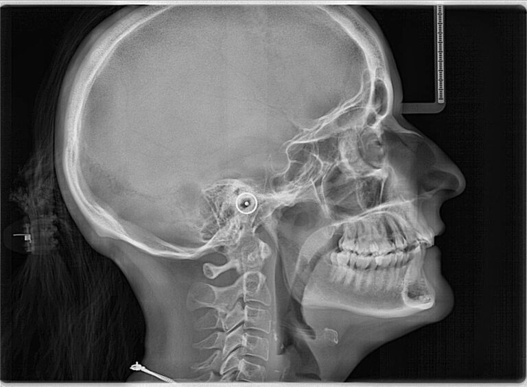 Cephalometric dental panoramic X-ray - I-Max Ceph Pro