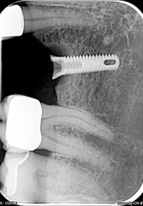 Owandy-CR2 - Dental Plate Scanner