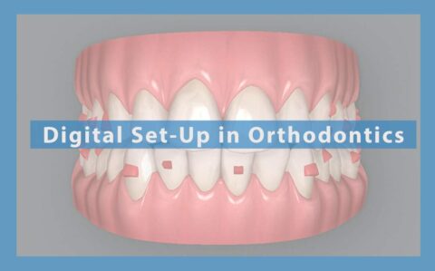 Digital Setup in Orthodontics