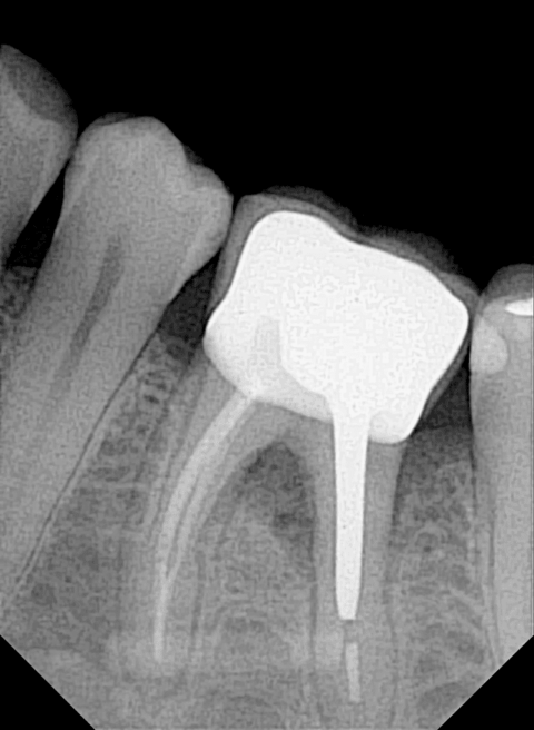 New OPTEO Dental Sensor - High-definition, reliable, and durable