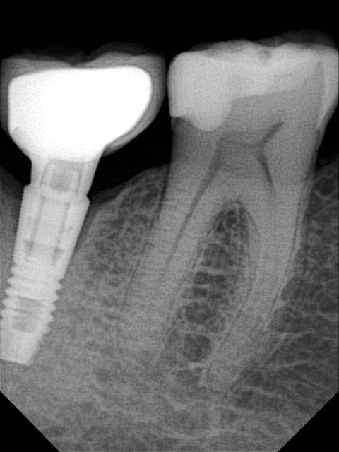 New OPTEO Dental Sensor - High-definition, reliable, and durable